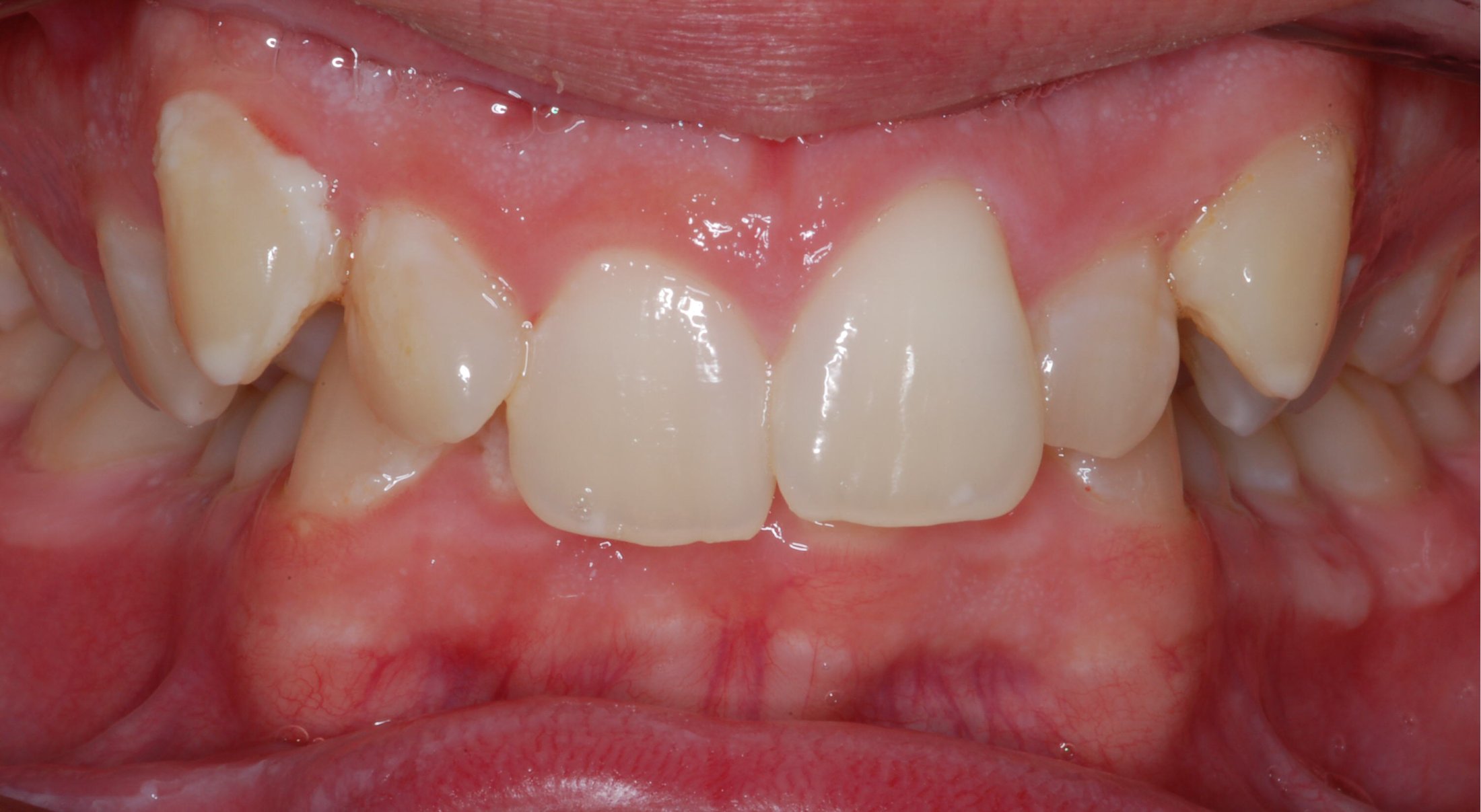 Common Orthodontic Issues Swedesboro NJ, Lempert Orthodontics : Susan ...