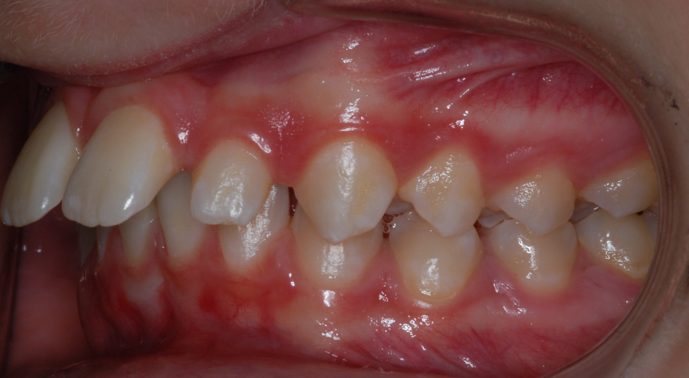 Common Orthodontic Issues Swedesboro NJ, Lempert Orthodontics : Susan ...