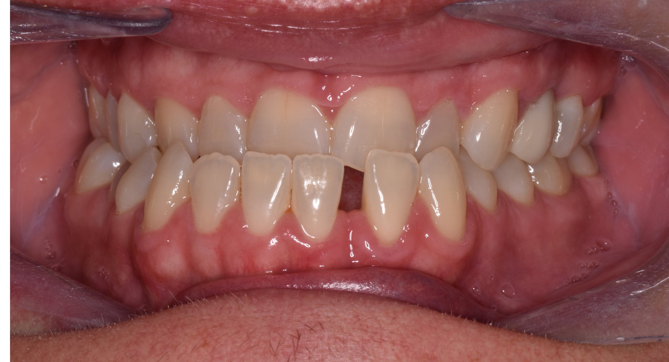 Common Orthodontic Issues Swedesboro NJ, Lempert Orthodontics : Susan ...